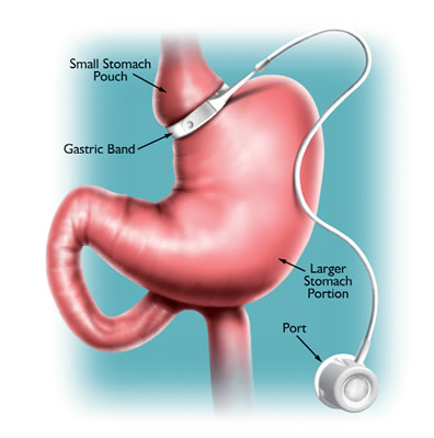 Kearney Clinic doctor says laparoscopic band surgery reduces or ...