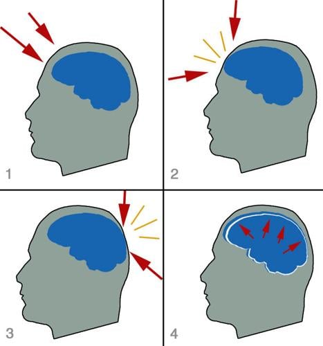 The anatomy of a concussion: How the perception of head injuries has ...