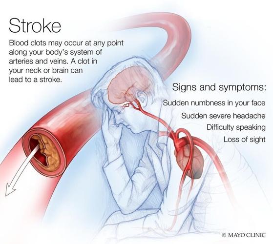Raising awareness: American Stroke Month