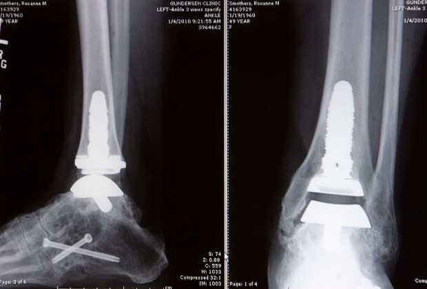 Galesville woman receives total ankle replacement