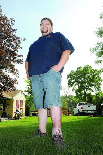 Flesh Eating Bacterial Infection Could Have Taken Mans Life Health