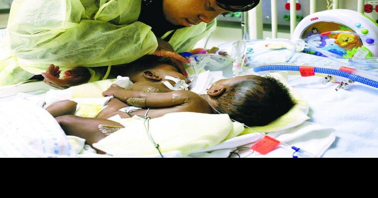 Conjoined twins fight for their lives | Health | leadertelegram.com