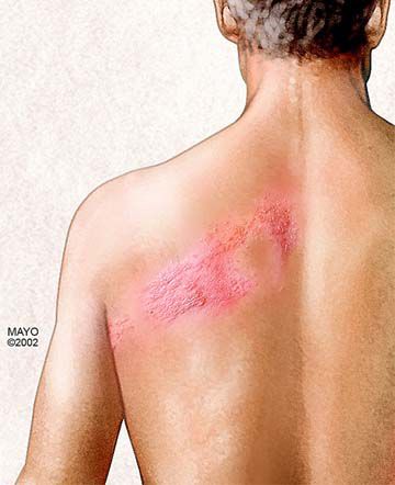 Respond quickly to signs and symptoms of shingles infection, providers ...