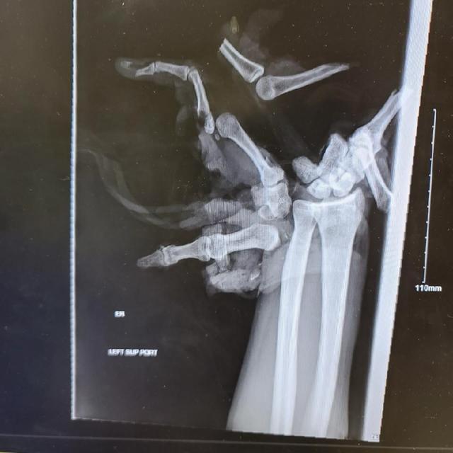 Verona man loses hand after fireworks accident