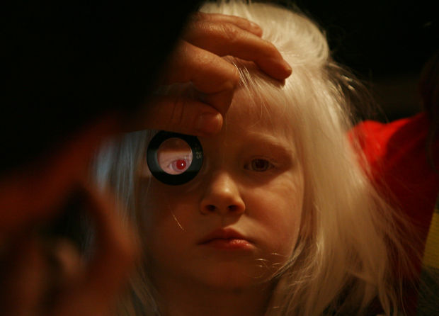 UW-Madison studies vision treatment for albinism