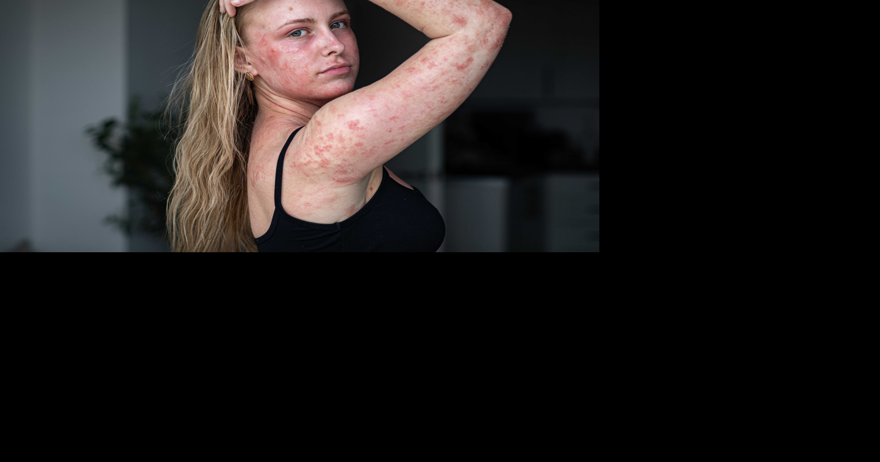 Woman left in agony after eczema cream leaves 95% of skin in pain ...