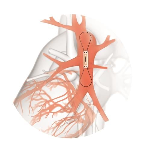 CVMC now offering innovative procedure for heart failure management ...