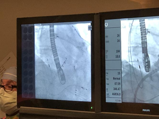 PHOTOS: Watchmen surgery performed at CarolinaEast | Local News ...