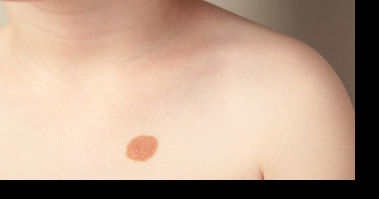 Moles vs. birthmarks: What's normal and what warrants a check | Homes ...
