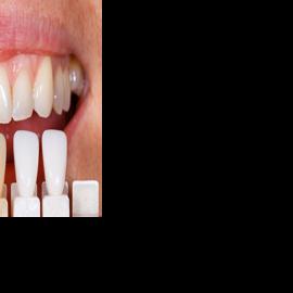 The importance of all-ceramic dental prosthetics in dentistry
