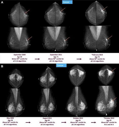 AI helps spot early warning signs of breast cancer sooner | Health ...