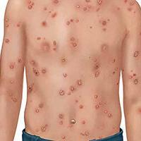 Community outbreak of chicken pox investigated in Henry County | News ...