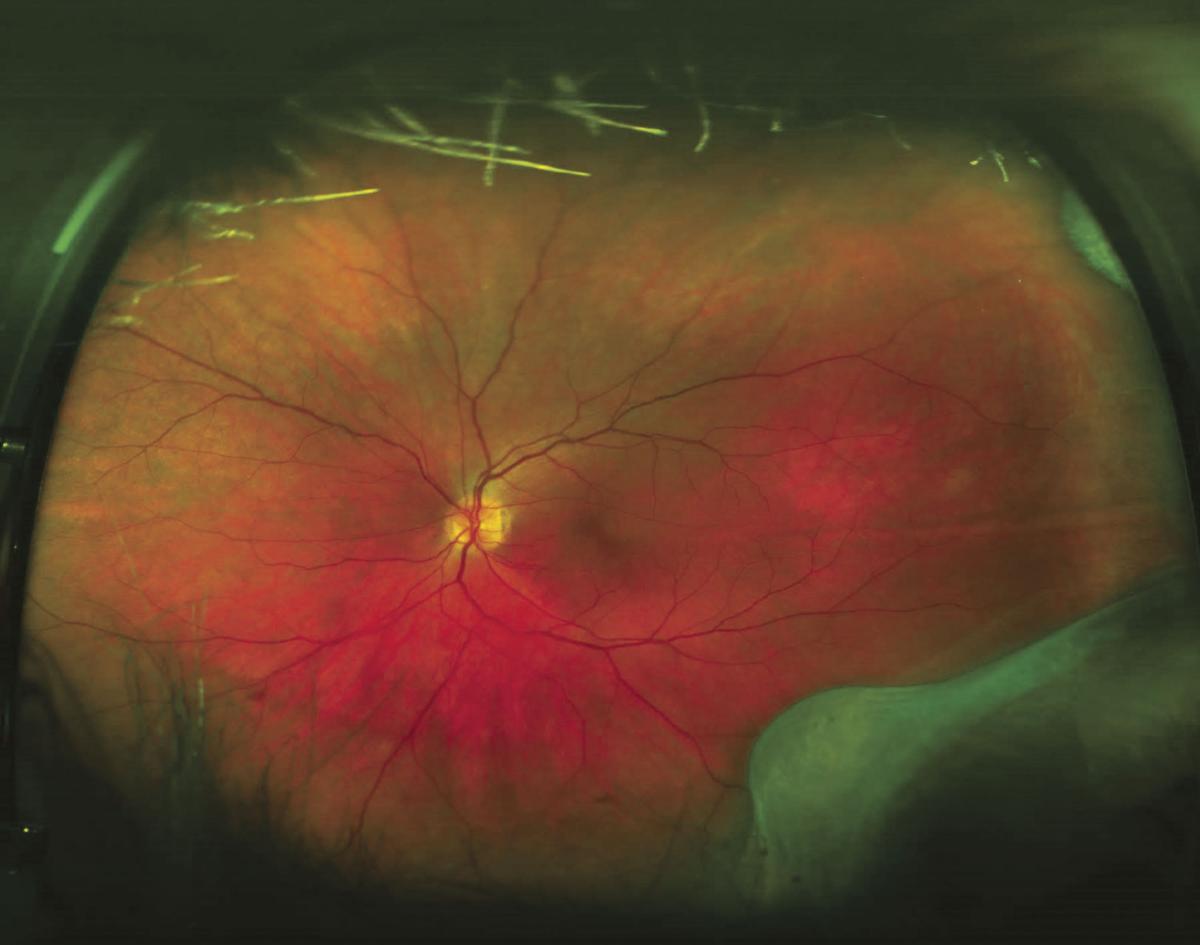 NP woman diagnosed with rare eye cancer | Local News | nptelegraph.com