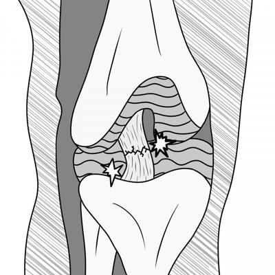 Soccer players recover from ACL injuries | Sports | ntdaily.com