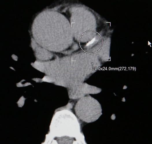 Northwest Indiana hospital system offers heart scans it says can save lives