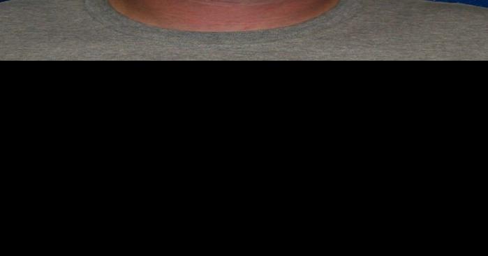 STEVE HANLON: H.C.'s Bachinski hits the ground running