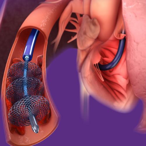 Methodist Hospitals takes an innovative, less invasive approach to ...