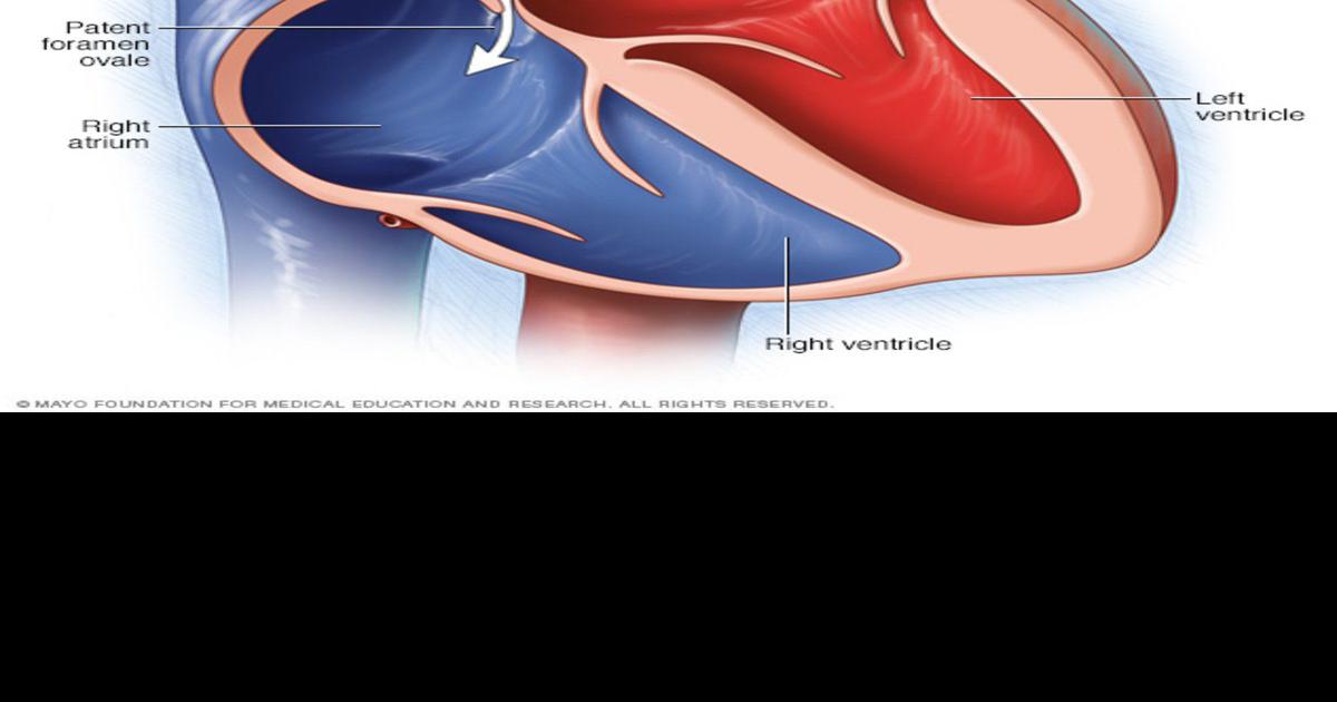 1 in 5 people have hole in heart; closure may prevent stroke | Posh ...