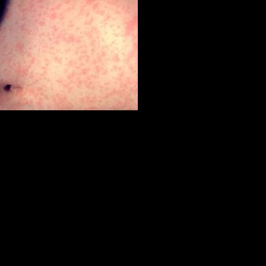 Measles Rash - CDC photo