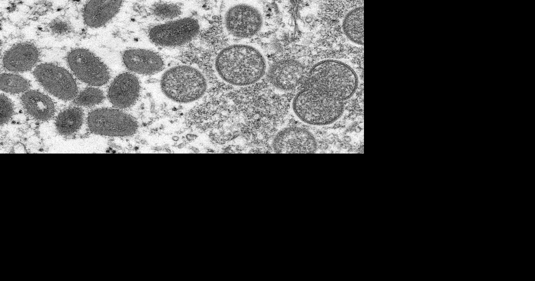 Ill. monkeypox case count at 152, CDC reports. Here's what you should know.