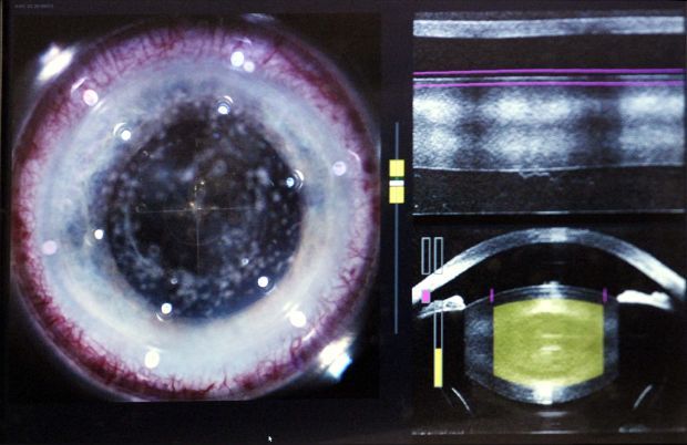 New tool gives doctors better way to remove cataracts
