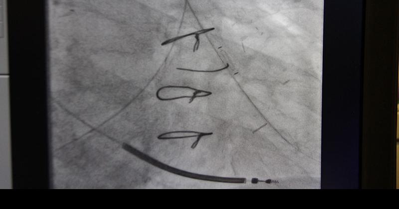 ‘Paper clip’ heart implant monitors problems, alerts doctor’s ...