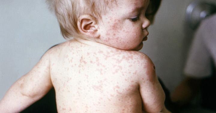 Arizona’s first measles cases of 2025 reported in Navajo County | News | paysonroundup.com