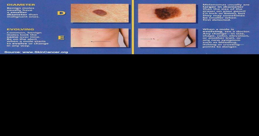 Not all skin changes mean cancer | Health | paysonroundup.com
