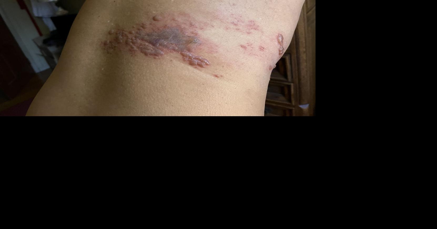 Tips to be Fit: Your risk of stroke increases if you have had shingles ...