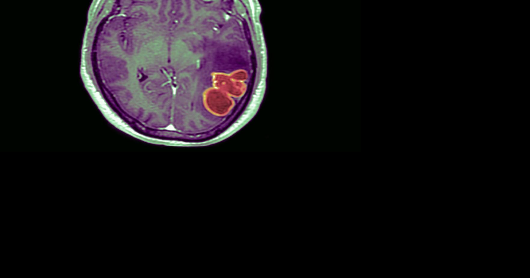 Brain abscesses increased nationally in children last winter, but ...
