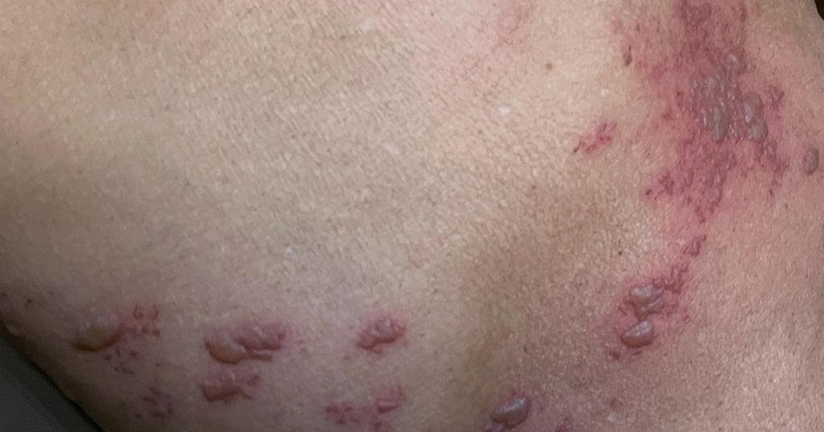 Tips to Be Fit: What you may expect if you have shingles | Health ...