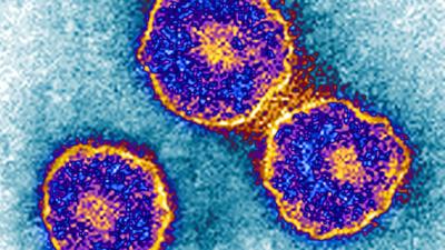 Measles is not the only disease on the rise. Mumps also may be making a ...