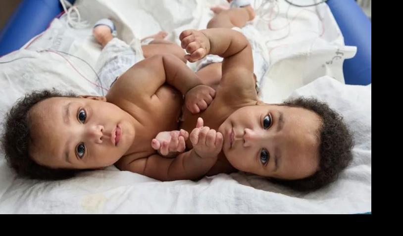 CHOP surgeons successfully separate conjoined twin boys after 8-hour ...