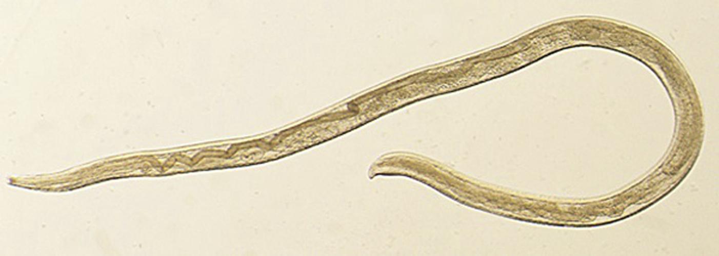 14 worms pulled from woman's eye after rare infection | | phillytrib.com