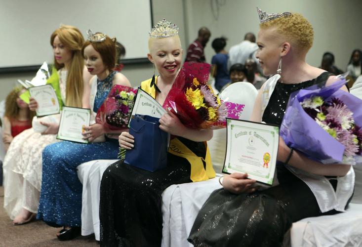 Albinism pageant in Zimbabwe joyfully breaks down prejudice | Lifestyle ...