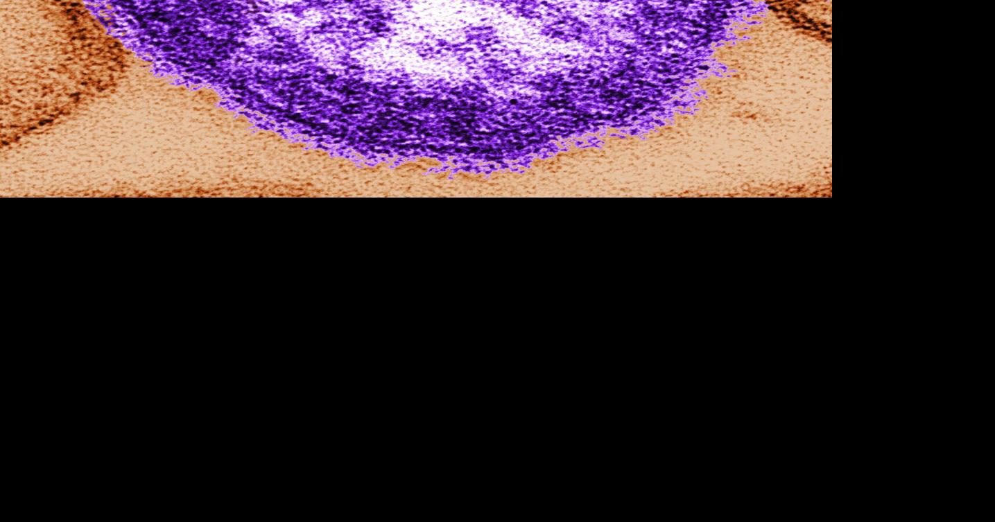 Measles case reported in Ohio | | portsmouth-dailytimes.com