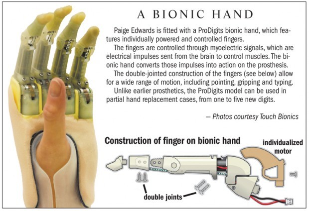 Bionic hand gives Lake George teen a new grip on life