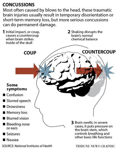 Concussions and the long, dangerous road to recovery