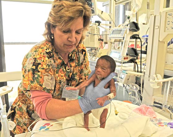 Health: More preemie babies face test of survival