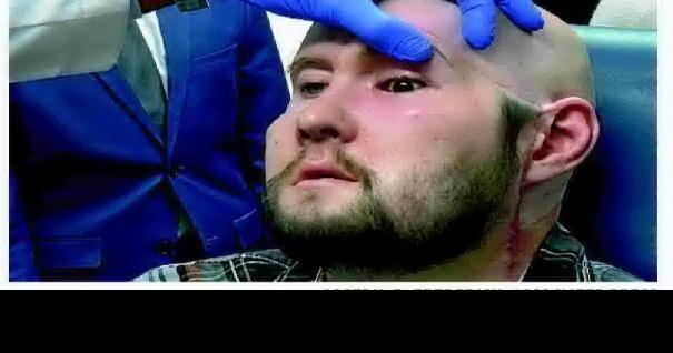 Man receives the first eye transplant plus a new face