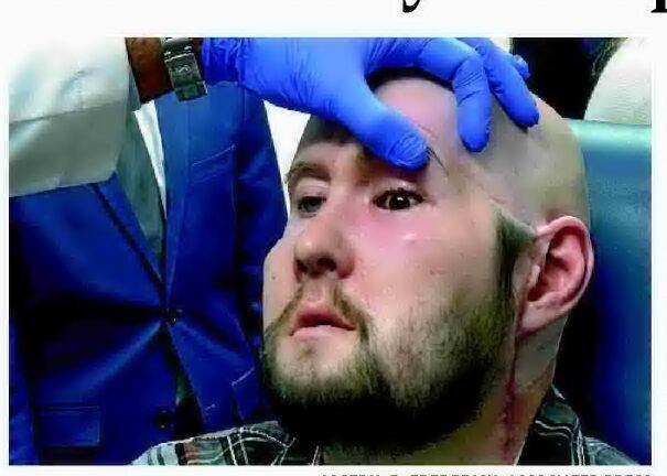 Man receives the first eye transplant plus a new face