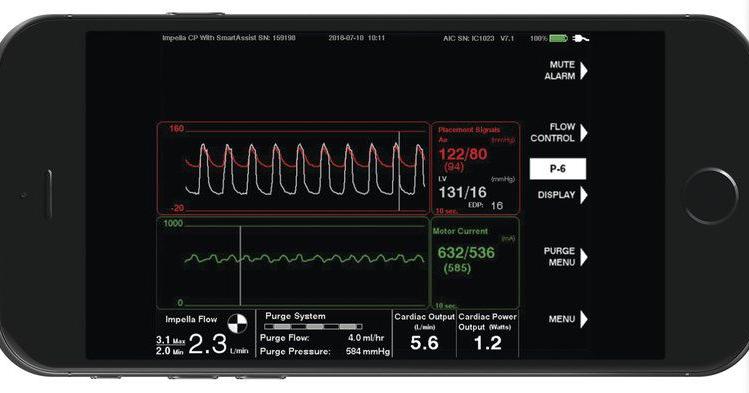 Heart pump maker Abiomed continues expansion track | Local News ...