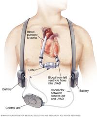 lvad device