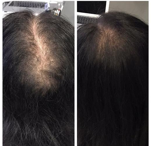 Stop Hair Loss for Good Without Surgery, Medication or Side Effects ...