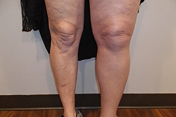 What You Should Know About DVTs | Health + Wellness | seenthemagazine.com