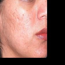 Treatment available for unsightly scars