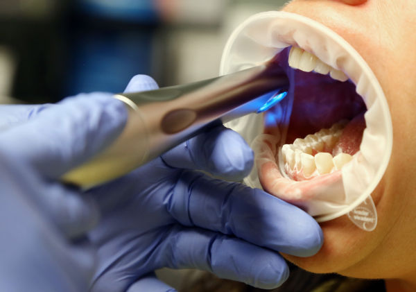 High-tech scanner replaces traditional dental impressions