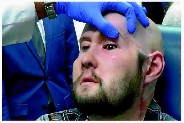 Man receives the first eye transplant plus a new face