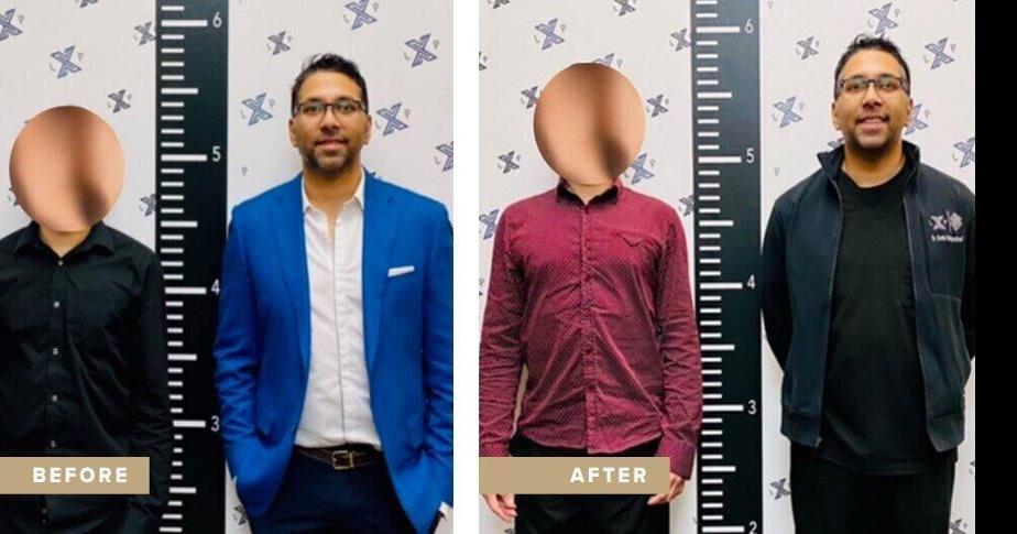 Is surgery to make you taller the new BBL for men?
