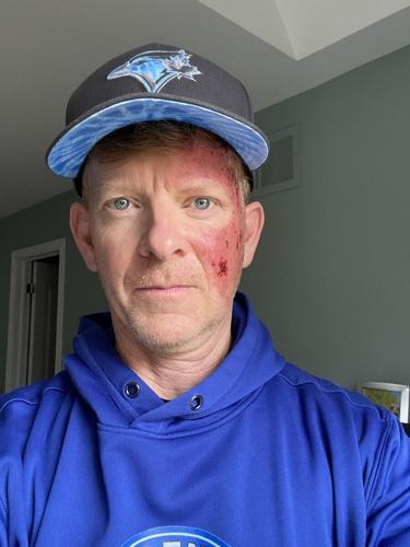 Jamie Campbell missed World Series to fend off skin cancer